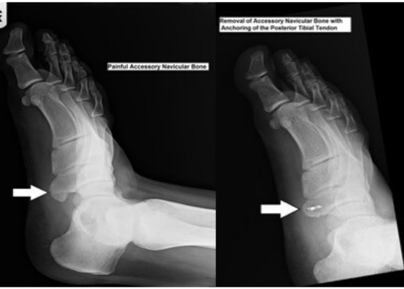 Before and After Surgery – North Shore Foot & Ankle