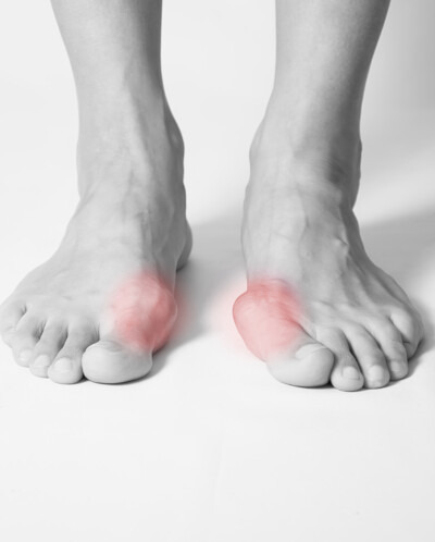Bunions – North Shore Foot & Ankle