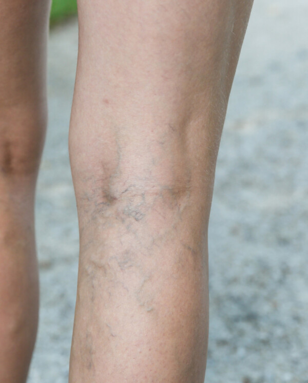 Deep Vein Thrombosis – North Shore Foot & Ankle