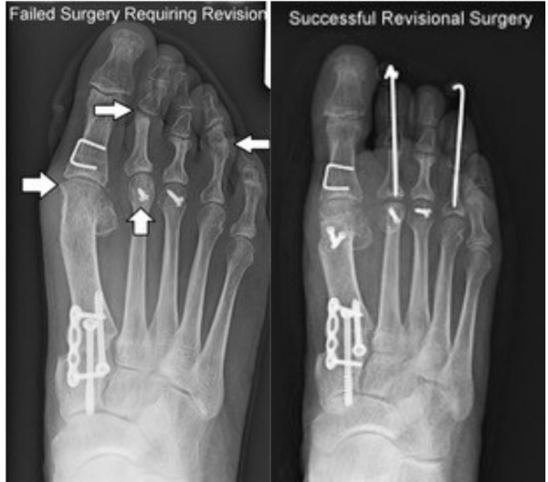 Before and After Surgery – North Shore Foot & Ankle