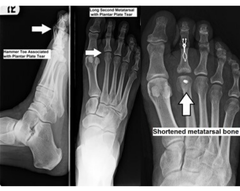 Before and After Surgery – North Shore Foot & Ankle